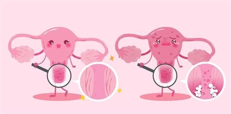 Vaginal candidiasis: causes, symptoms and treatment – Perfect Shape Fit